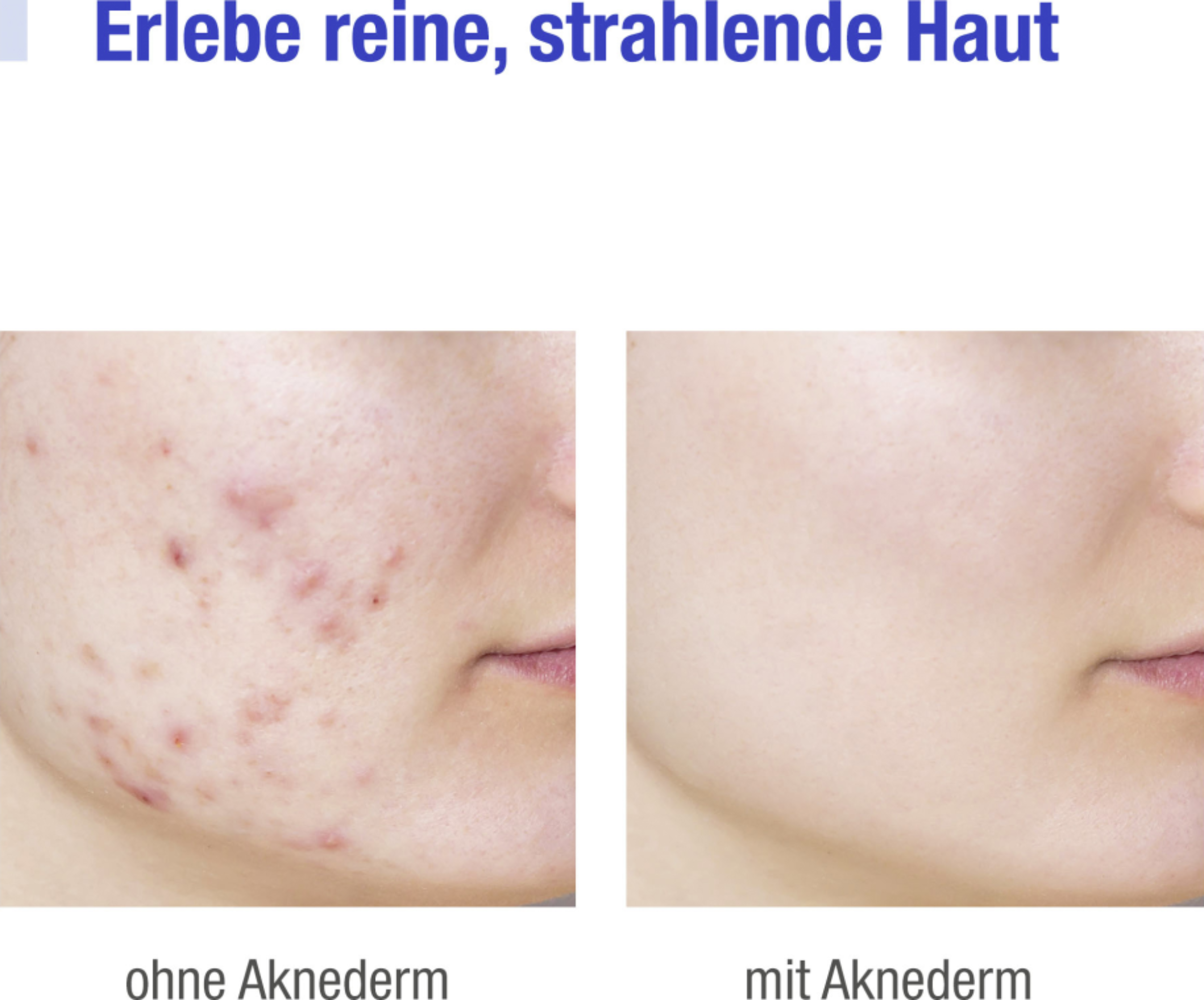 Aknederm Tinktur sensitive Hautpflege online kaufen | rossmann.de